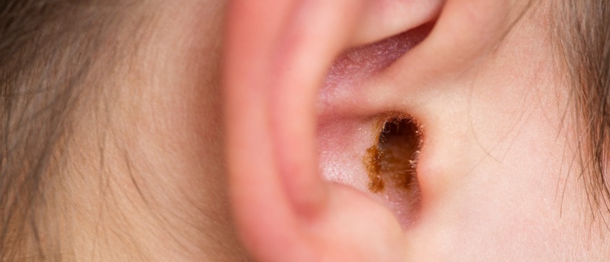 How to Know if Your Tinnitus is Temporary or Permanent? | Aanvii Hearing